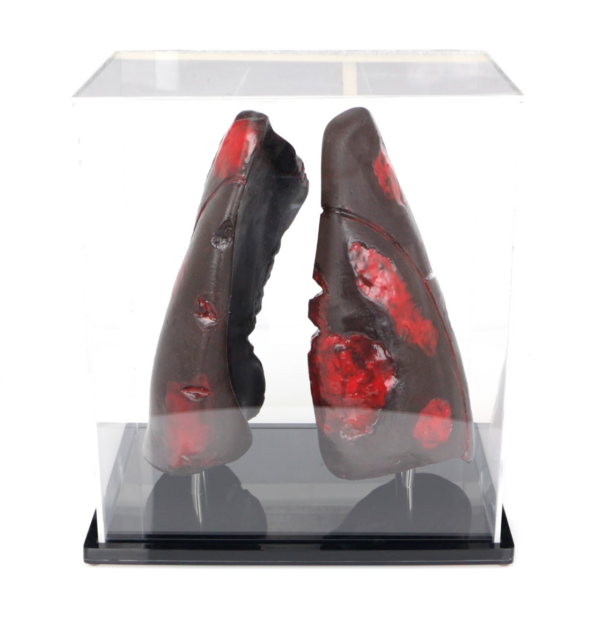 Anatomical Model for Lung Pathologies - Pro Delphus